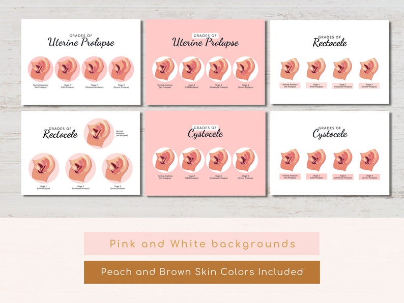 Types of Pelvic Organ Prolapse | Rectocele Stages | Cystocele Stages ...