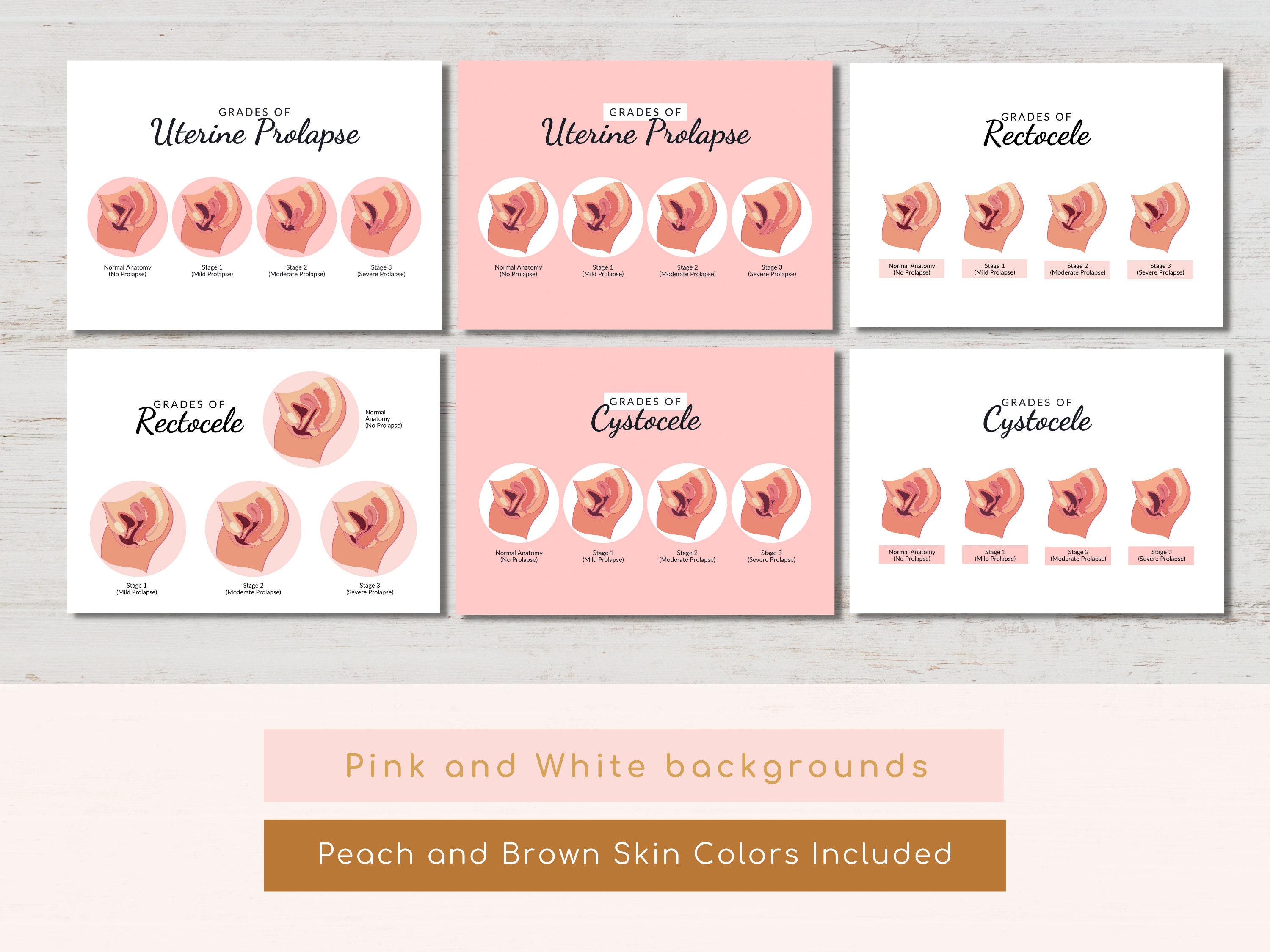 Types of Pelvic Organ Prolapse | Rectocele Stages | Cystocele Stages ...