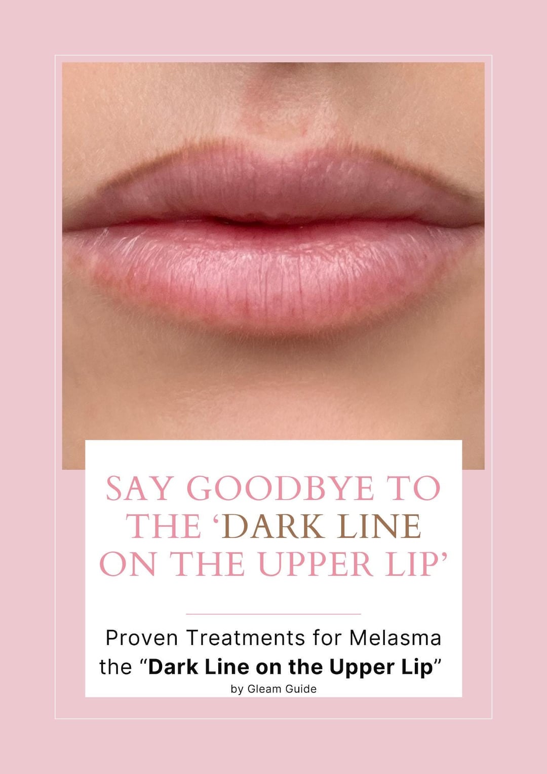 Lip Melasma, Dark Line on the Upper Lip, Dark Lips, How to Treat, How ...
