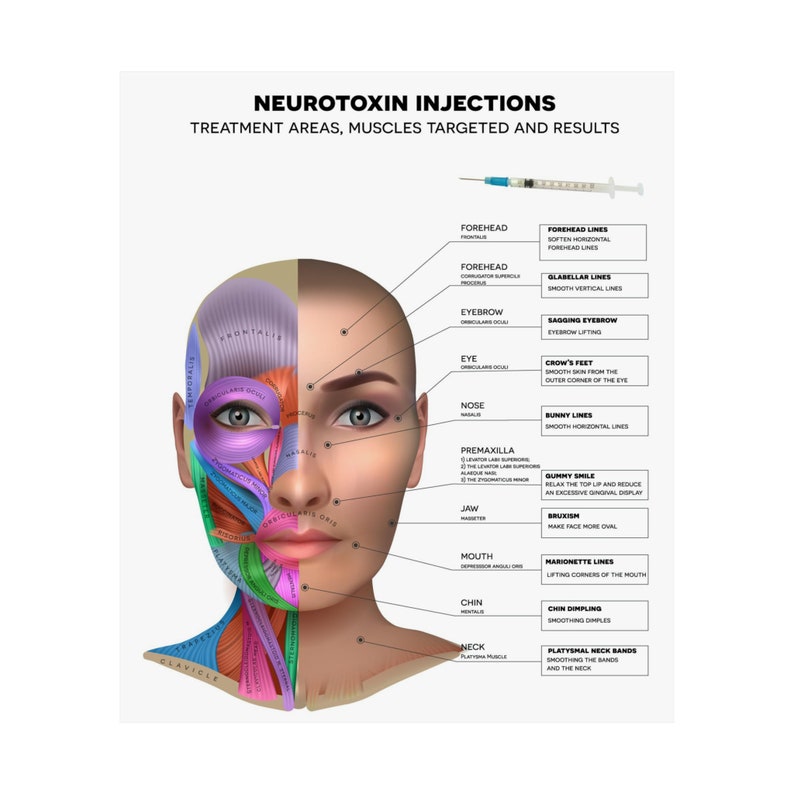 Neurotoxin Injections Treatment Areas, Muscles Targeted, Results - Medical Spa Decor Consult ...