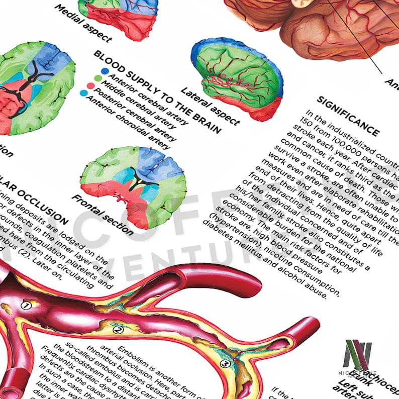 The Anatomy of Stroke / Brain Diagram / Neuro for Large Poster Print ...