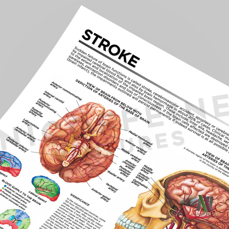 The Anatomy of Stroke / Brain Diagram / Neuro for Large Poster Print ...