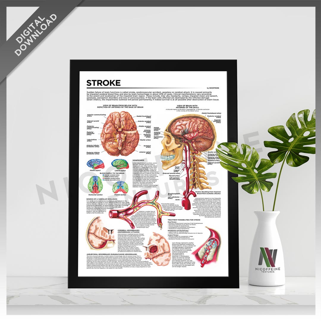 The Anatomy of Stroke / Brain Diagram / Neuro for Large Poster Print ...