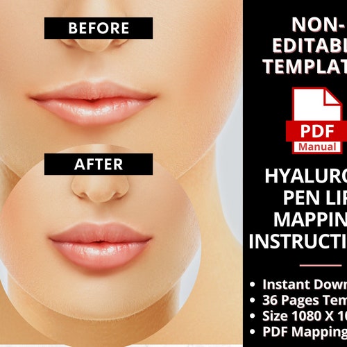 Hyaluron Pen Lip Mapping Lip Map Lip Mapping Techniques - Etsy