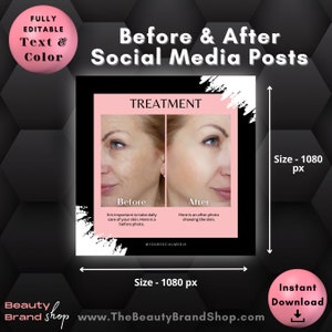 Skincare Before and After Templates, Editable Esthetician Instagram ...
