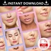 Hyaluron Pen Nasolabial Folds Mapping, Nasolabial Fold Fillers ...