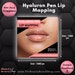 Lip Mapping, Hyaluron Pen Lip Mapping, Lip Map, Lip Blush Mapping, Lip ...