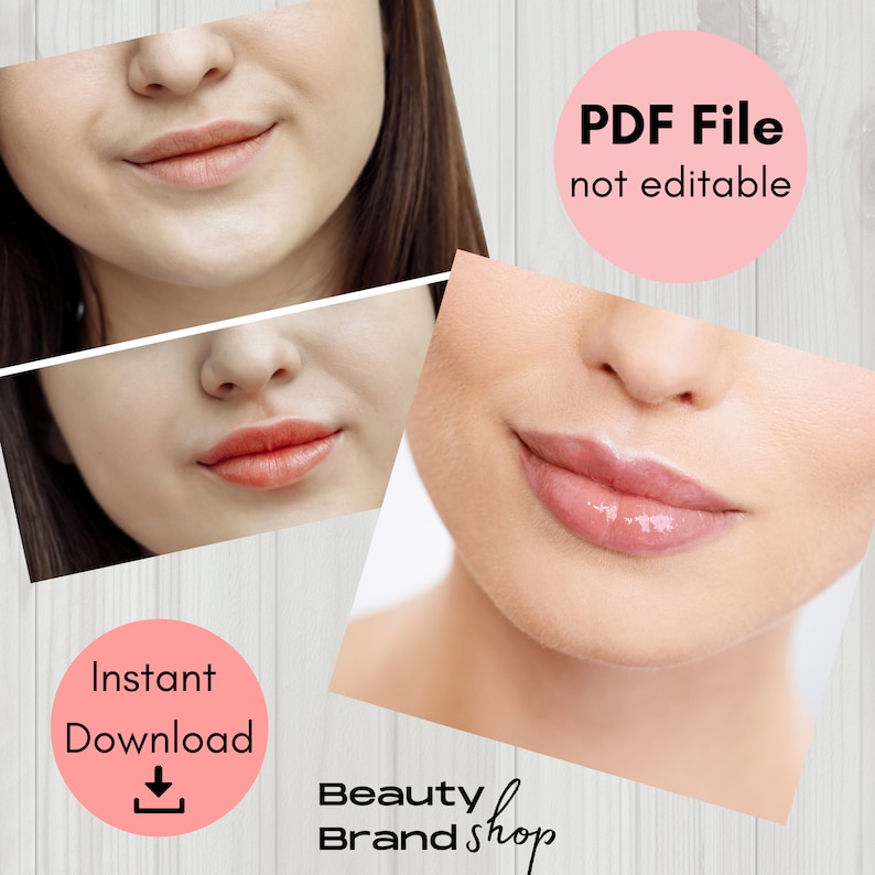 Hyaluron Pen Nasolabial Folds Mapping, Nasolabial Fold Fillers ...