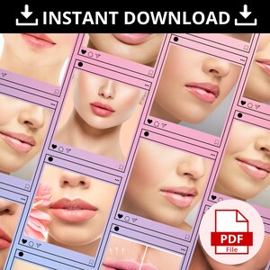 Hyaluron Pen Mapping, Lip Mapping, Nasolabial Folds Mapping, Marionette ...