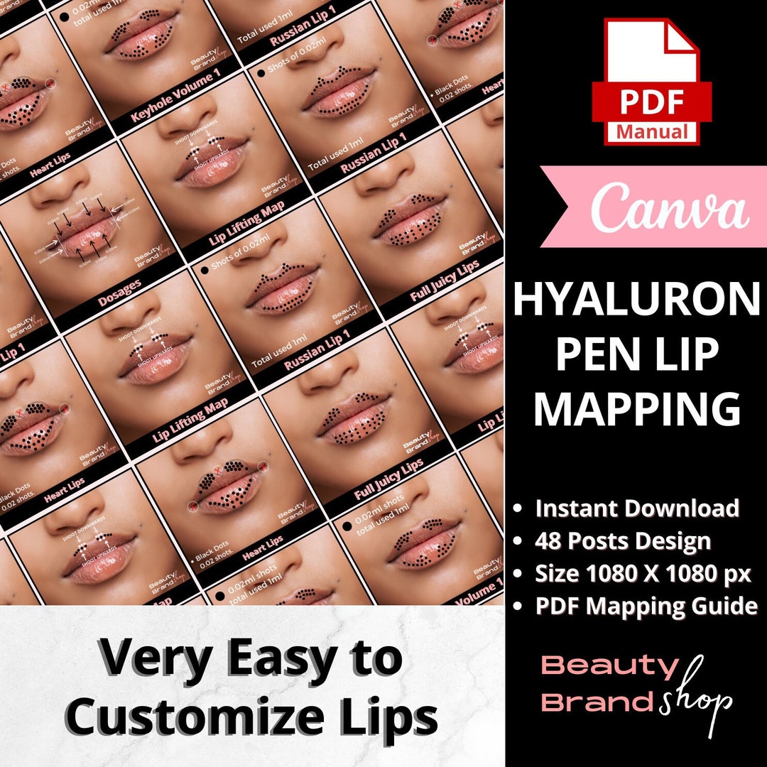 Hyaluron Pen Lip Mapping, Lip Map, Lip Mapping Techniques, Russian Lip ...