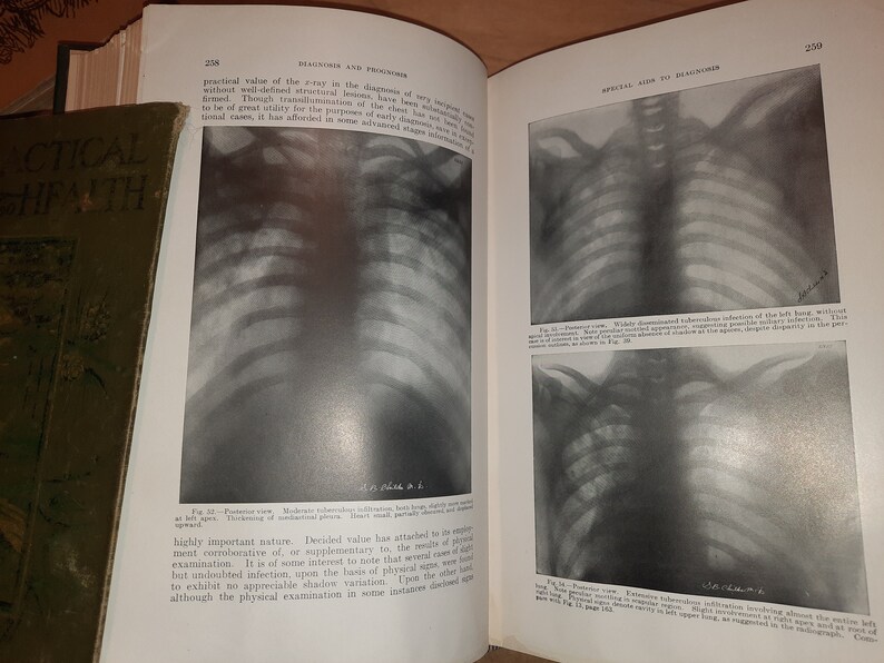 Pulmonary Tuberculosis and Its Complications sherman Bonney Medical ...