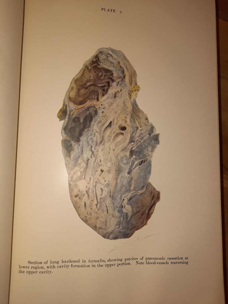 Pulmonary Tuberculosis and Its Complications sherman Bonney Medical ...