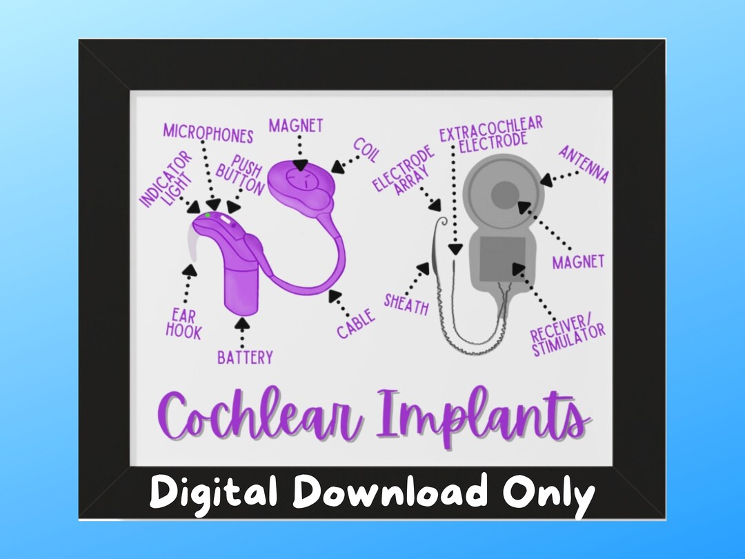 Cochlear Implant Digital Download Only | Cochlear Implants Diagram ...