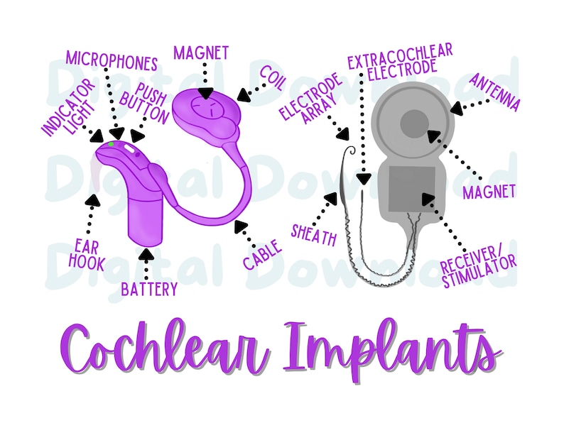 Cochlear Implant Digital Download Only | Cochlear Implants Diagram ...