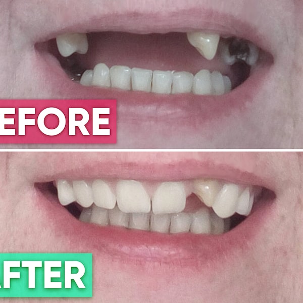 Denture Diy Denture Kit - Etsy