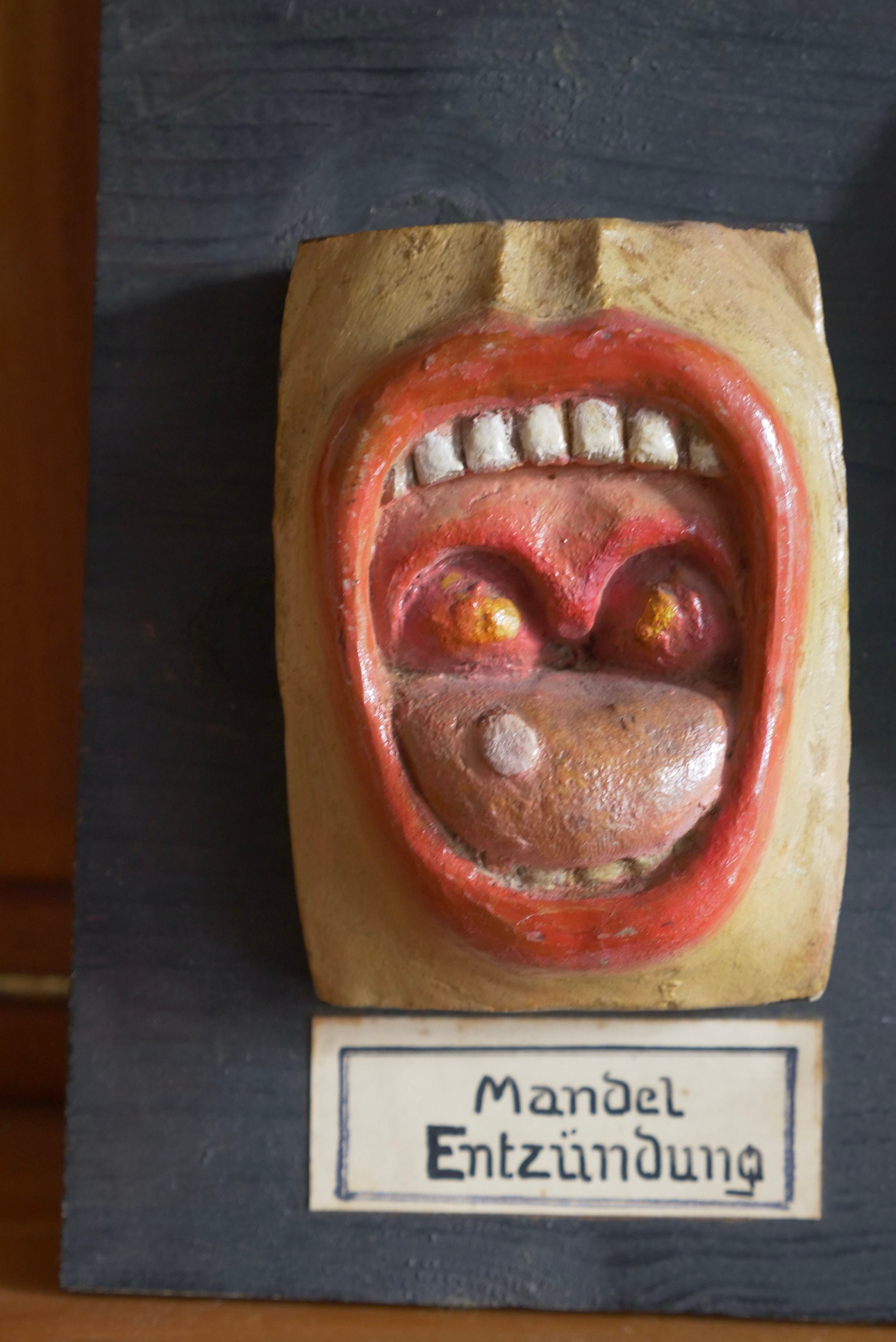 Vintage DIPHTHERIA in Mouth DIAGNOSIS Educational Model Late 19th Century - Etsy