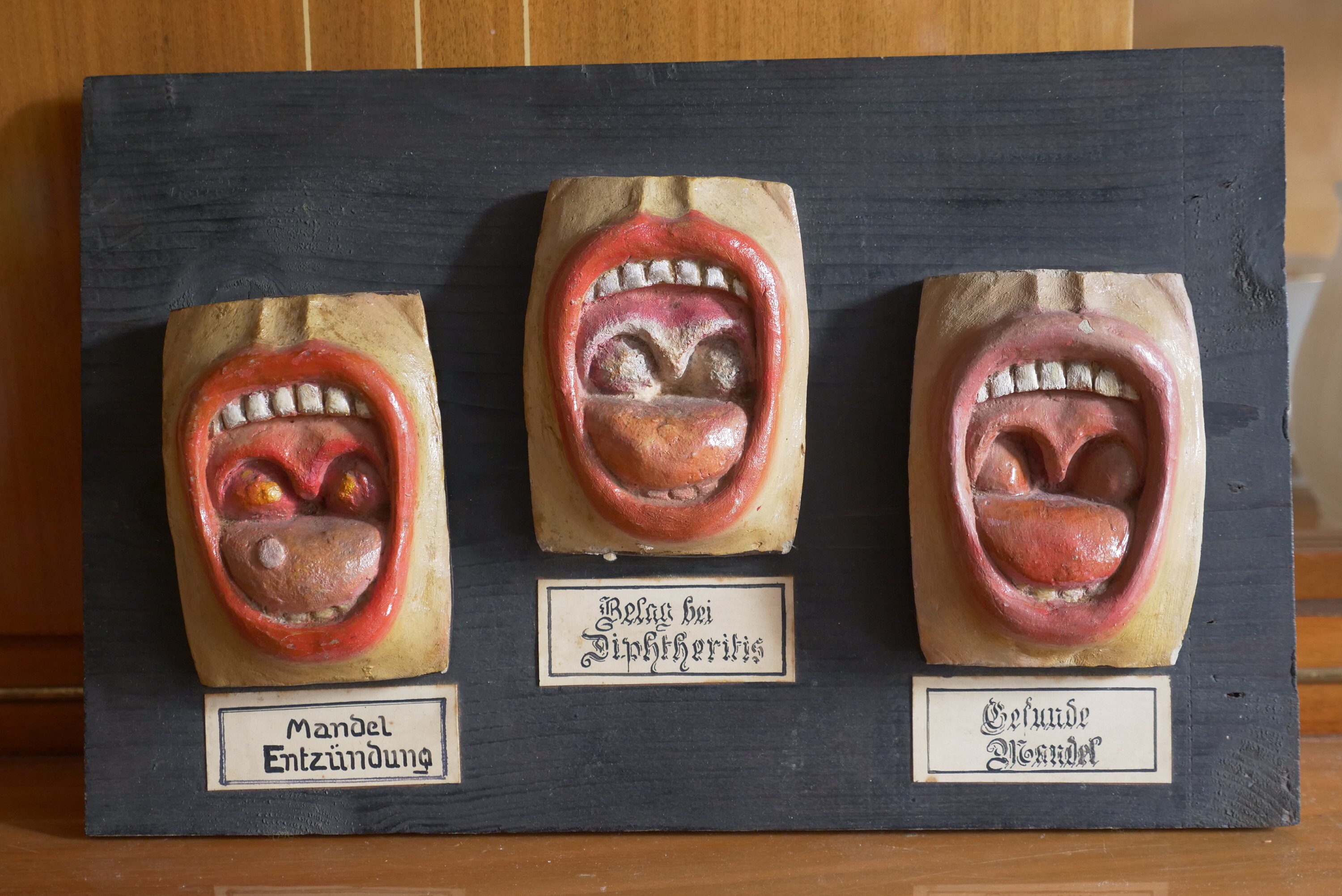 Vintage DIPHTHERIA in Mouth DIAGNOSIS Educational Model Late 19th Century - Etsy