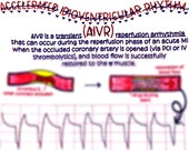 Accelerated Idioventricular Rhythm AIVR - Etsy