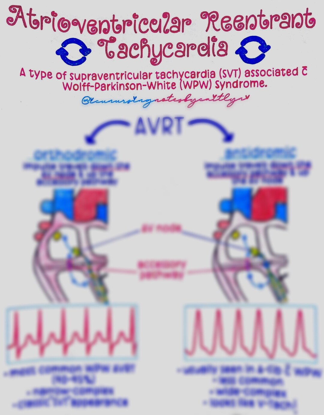 Atrioventricular Reentry Tachycardia (AVRT) - Etsy