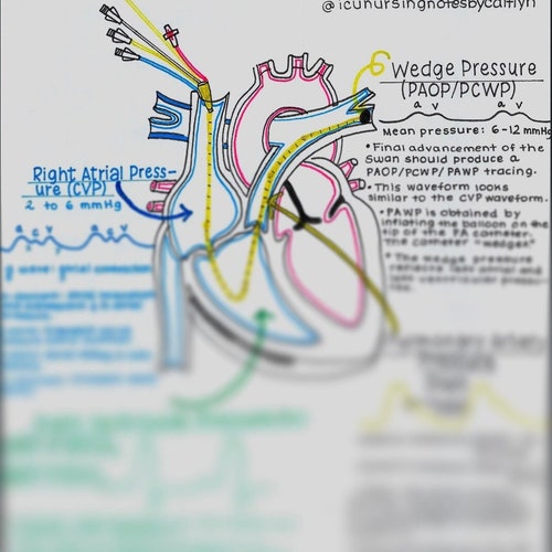 Anatomy of a Swan-ganz/pulmonary Artery Catheter PAC & - Etsy