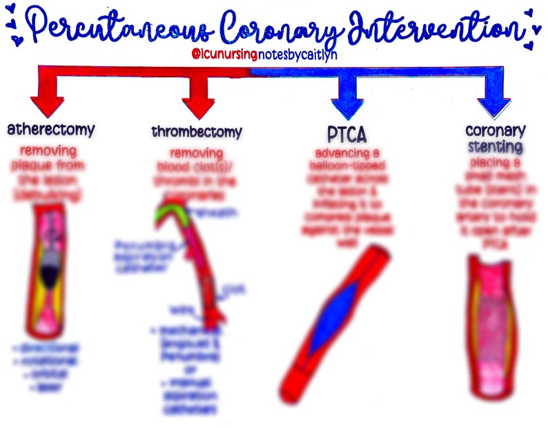 Percutaneous Coronary Intervention (PCI) - Etsy