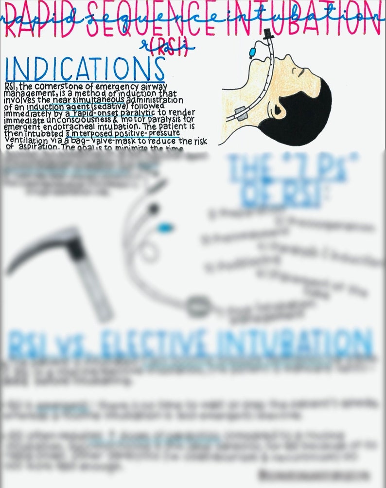 Rapid Sequence Intubation (RSI) - Etsy