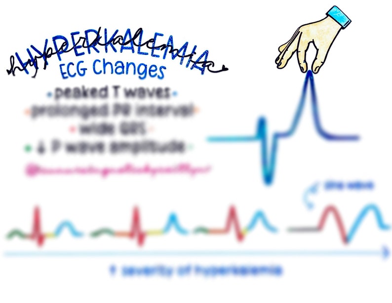 Hypokalemia & Hyperkalemia EKG Changes - Etsy