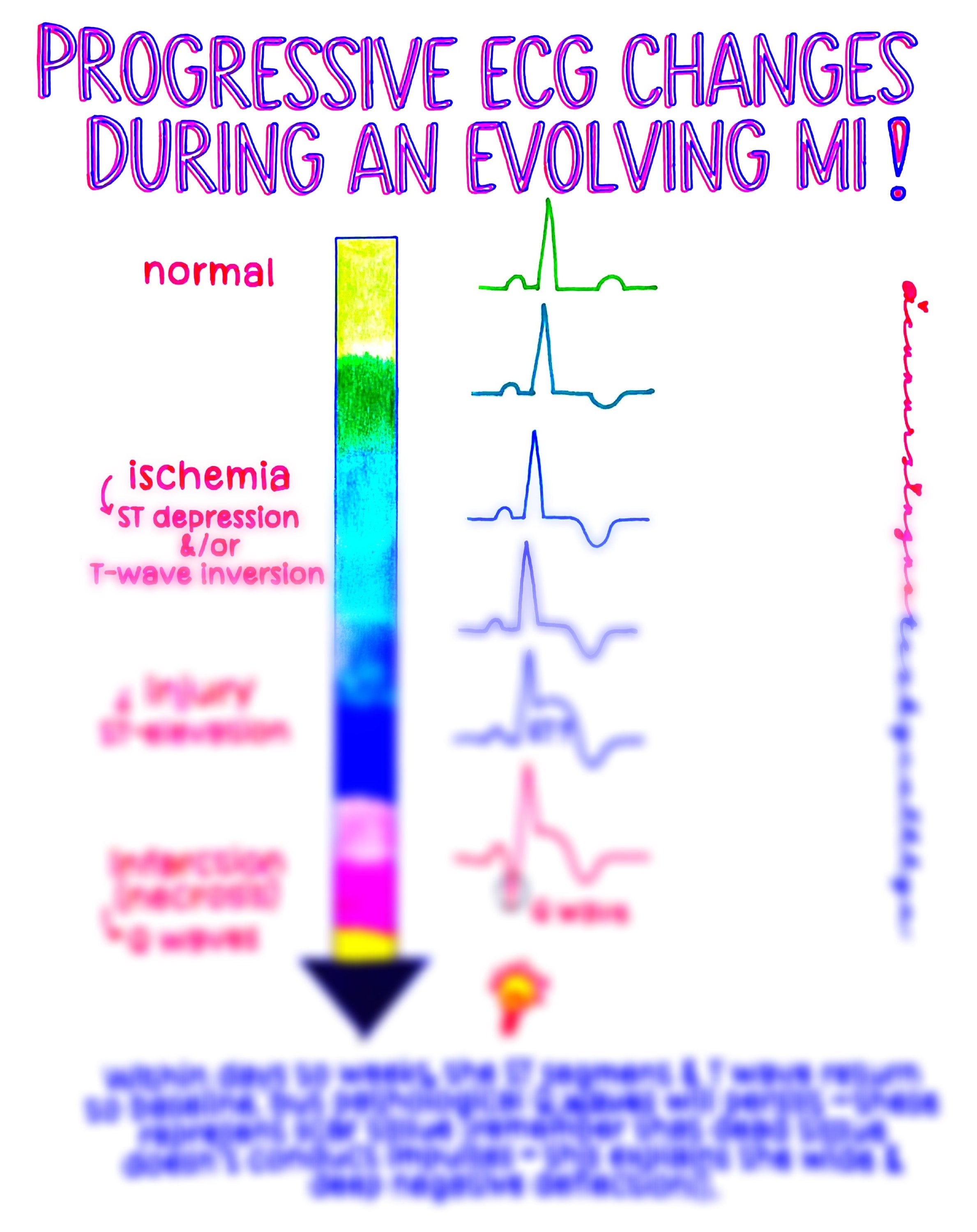 STEMI ECG Changes - Etsy