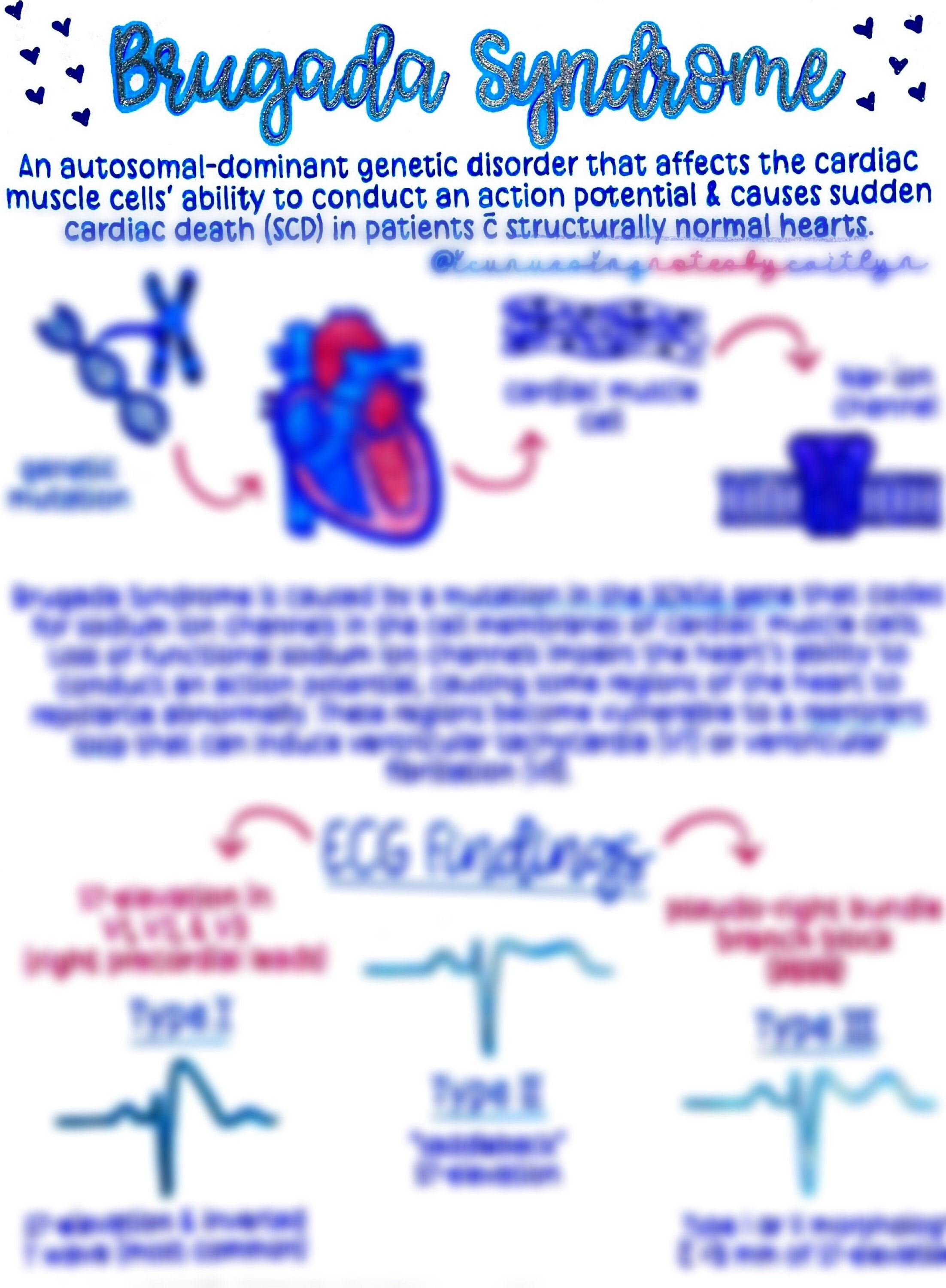 Brugada Syndrome - Etsy