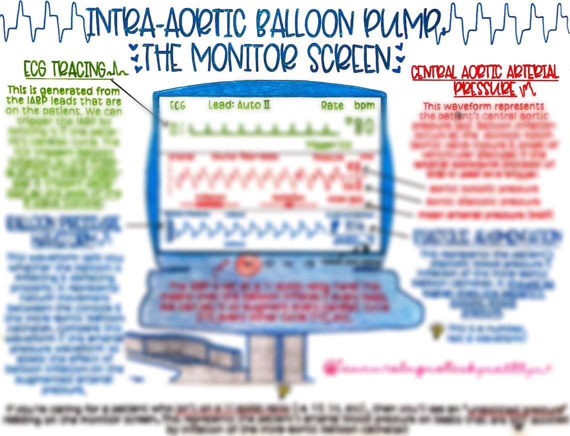 Intra-aortic Balloon Pump (IABP) Waveforms - Etsy