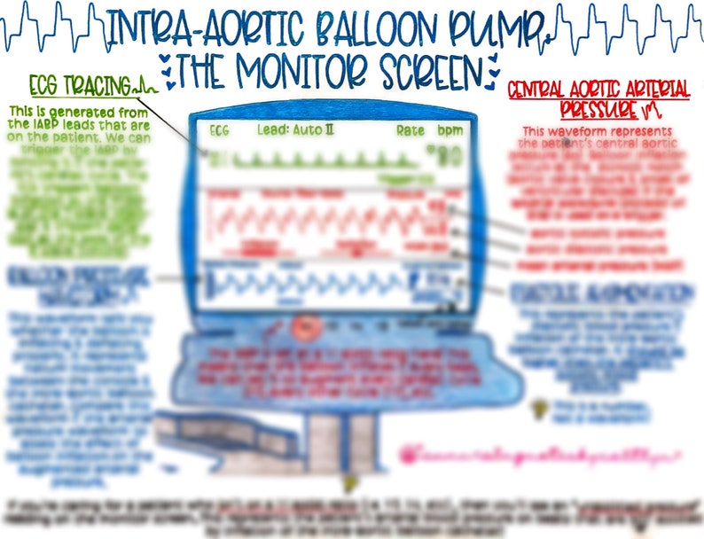 Intra-aortic Balloon Pump (IABP) Waveforms - Etsy