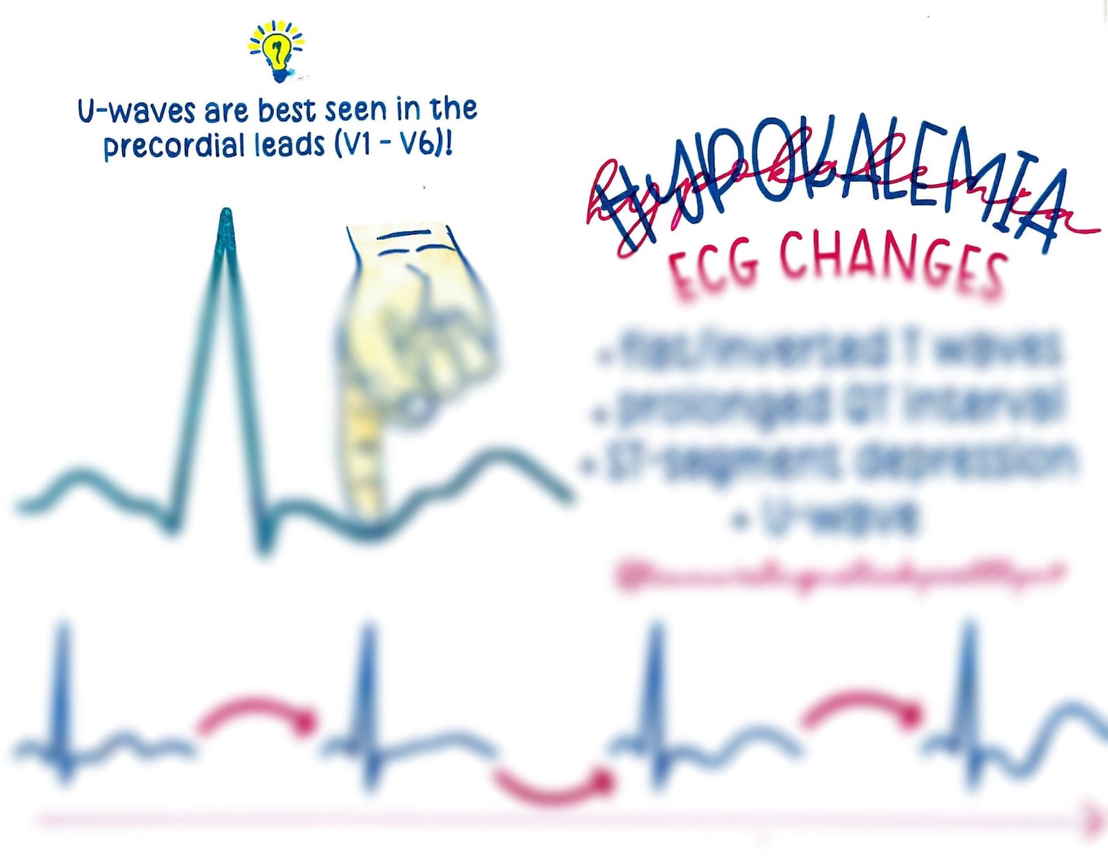 Hypokalemia & Hyperkalemia EKG Changes - Etsy