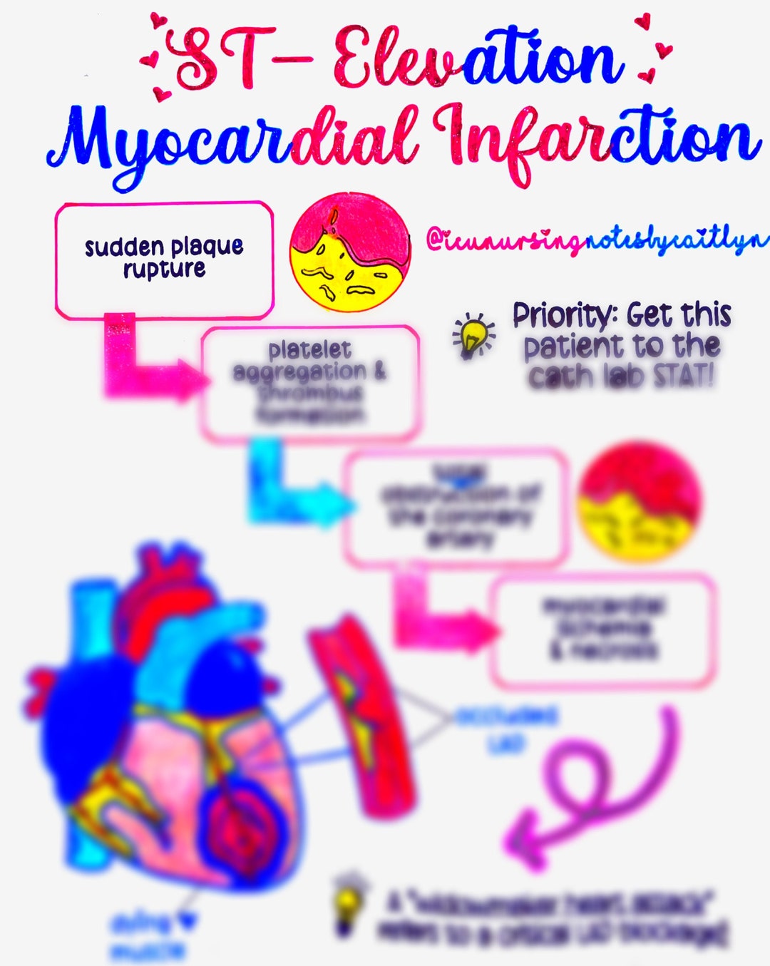 Pathophys of a STEMI - Etsy