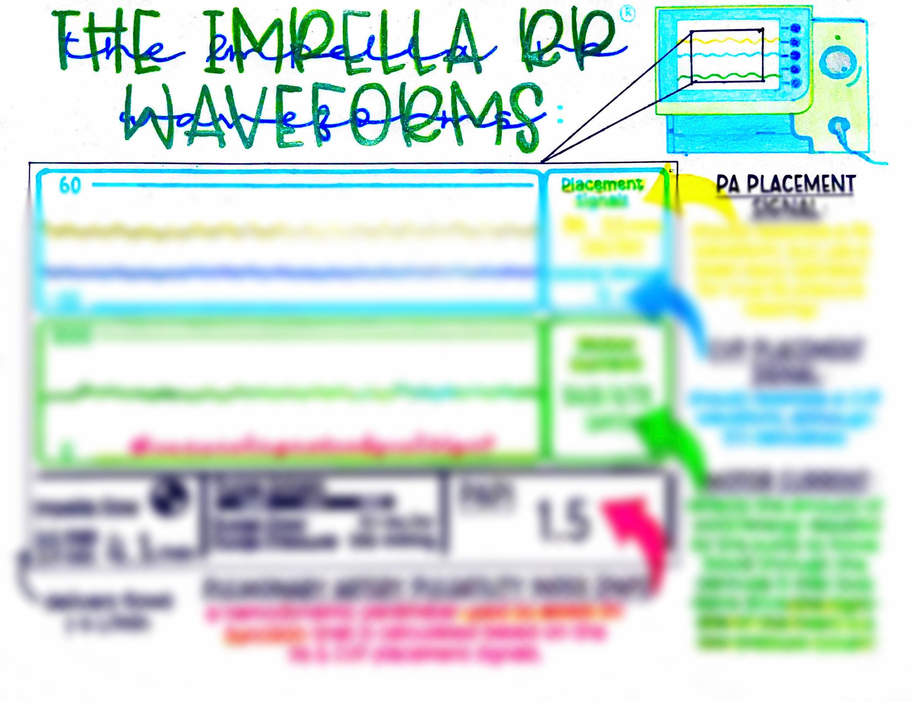 The Impella RP® & Waveforms - Etsy