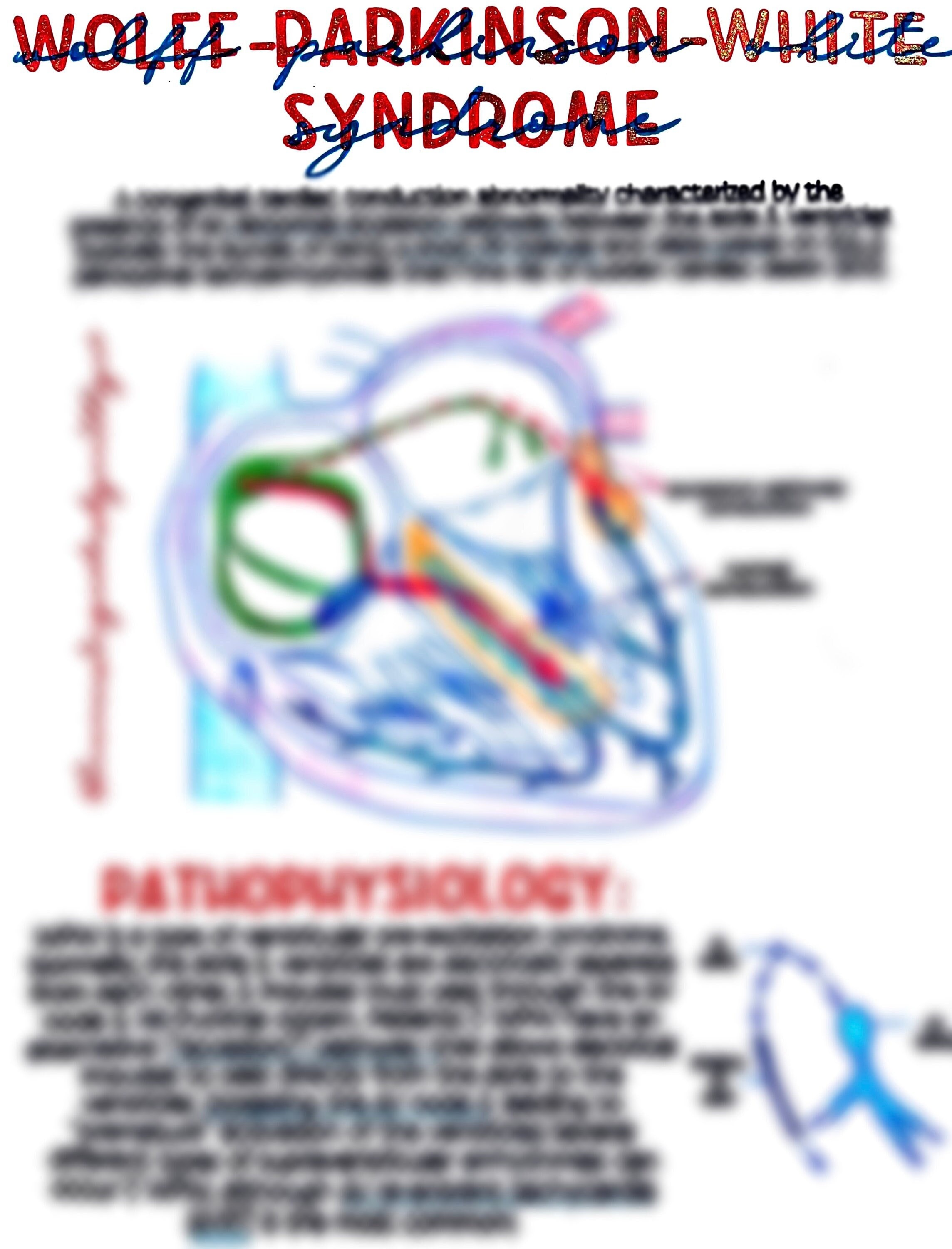 Wolff-parkinson-white Syndrome & Pattern - Etsy