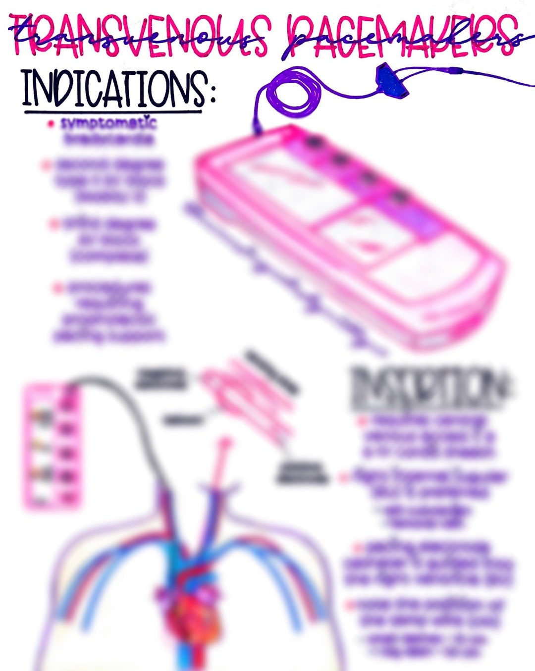 Transvenous Pacing Indications & Insertion - Etsy