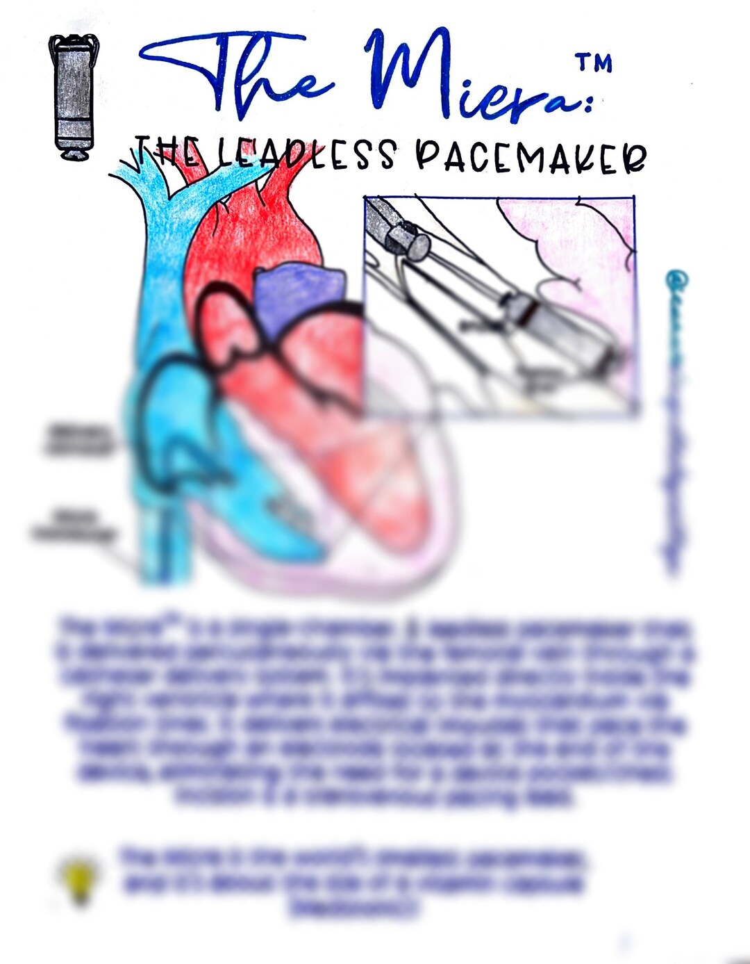 Leadless Pacemaker micra - Etsy