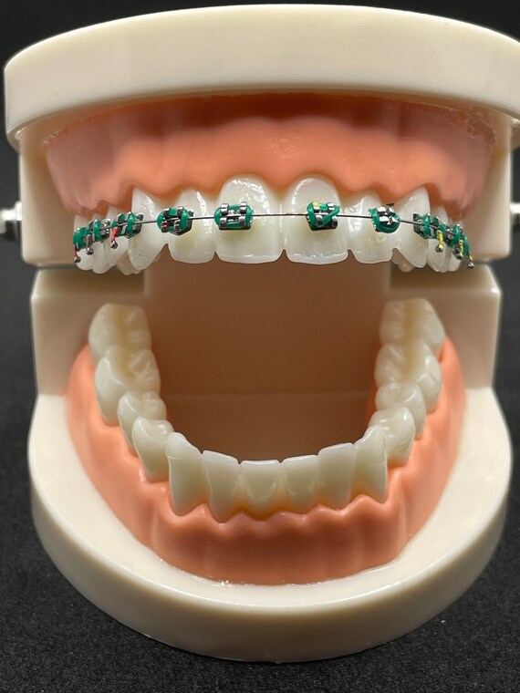 Brackets De Color Verde Lima Para Los Dientes Tratamiento Con