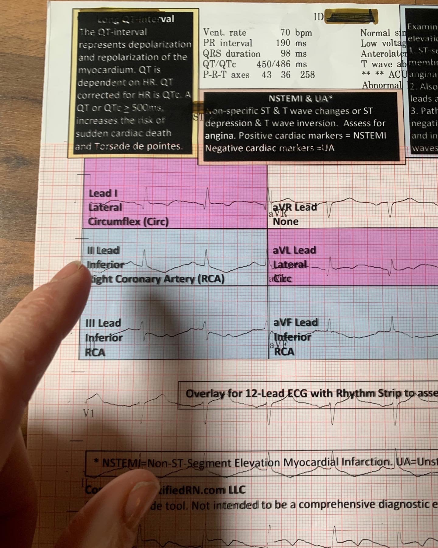 Cardiac Bundle: 2 12-lead ECG Overlays and 4 Instant Nurse Expert ...