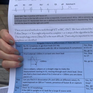 SVT Vs VTACH 12-lead ECG Overlay - Etsy