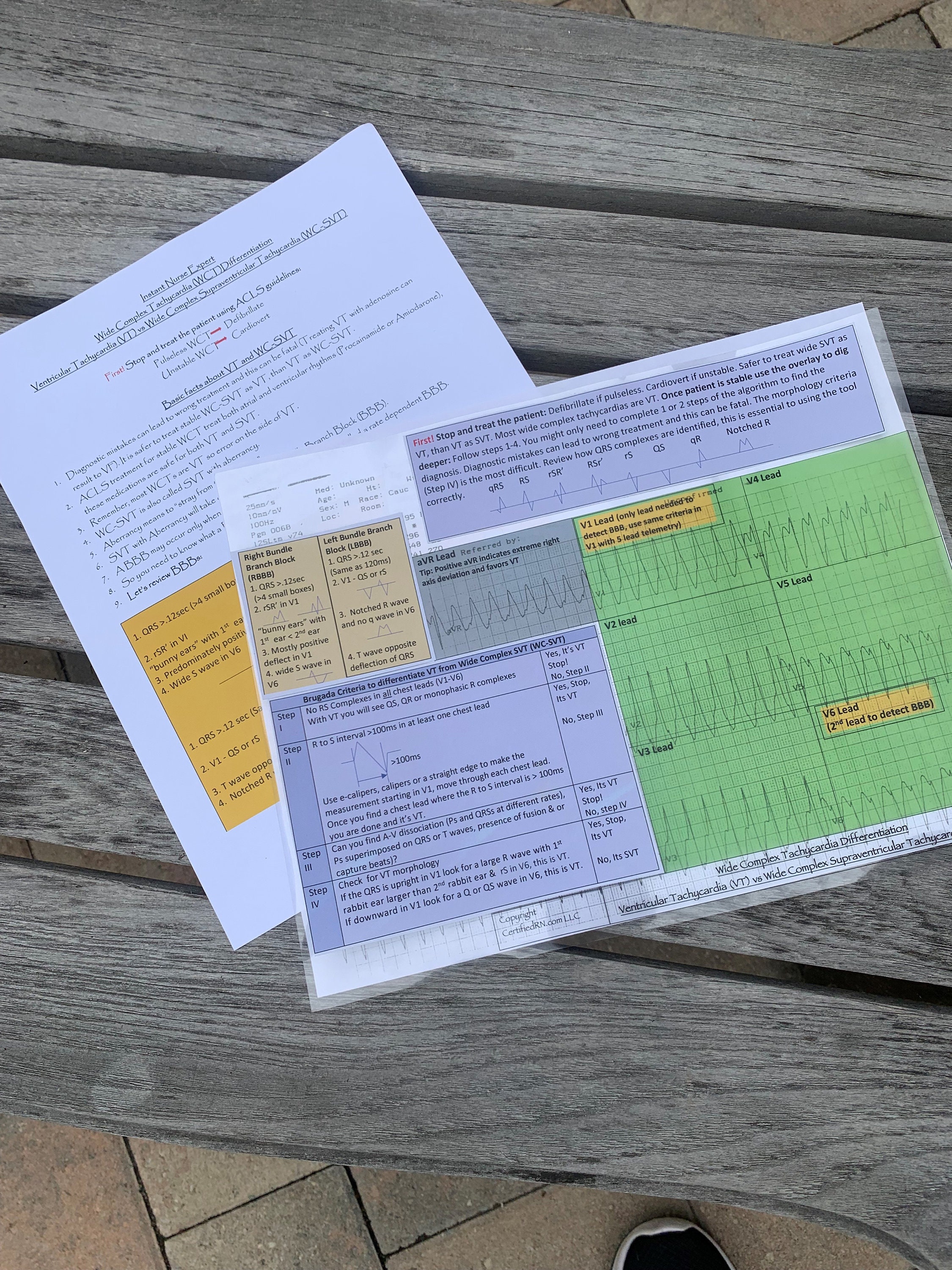 SVT Vs VTACH 12-lead ECG Overlay - Etsy