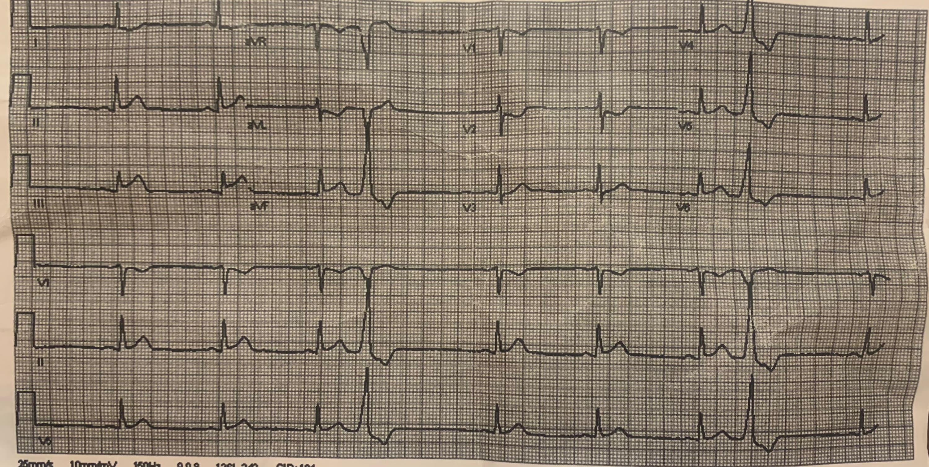 Need help with STEMI identification? We can help!! — Certified RN