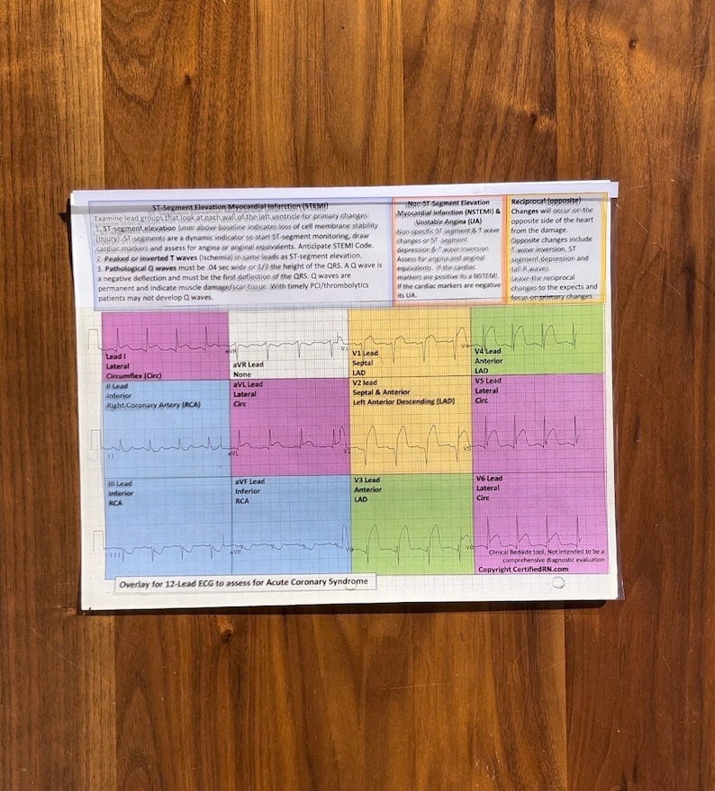 12-lead ECG Overlay to Detect STEMI/NSTEMI ( 2 Included) - Etsy
