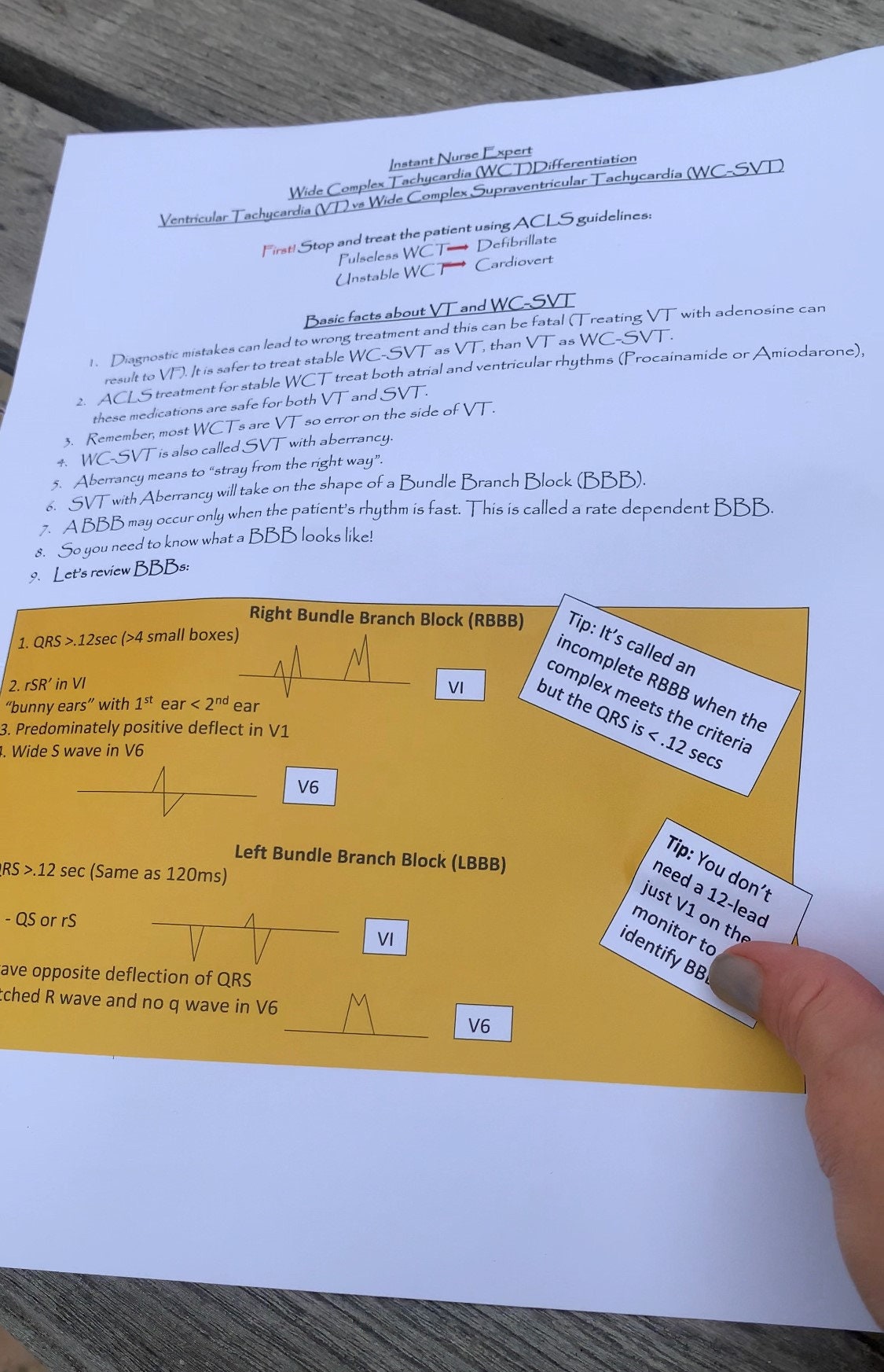 SVT Vs VTACH 12-lead ECG Overlay - Etsy