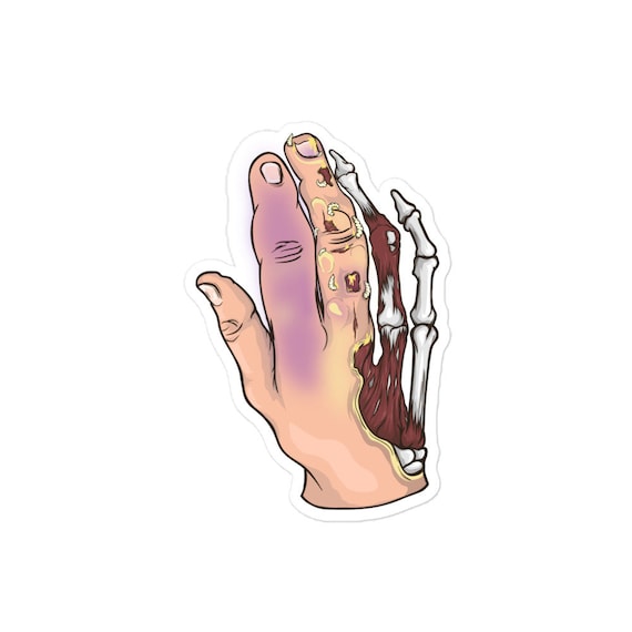 5 Stages of Decay Hand Human Decomposition Forensic - Etsy