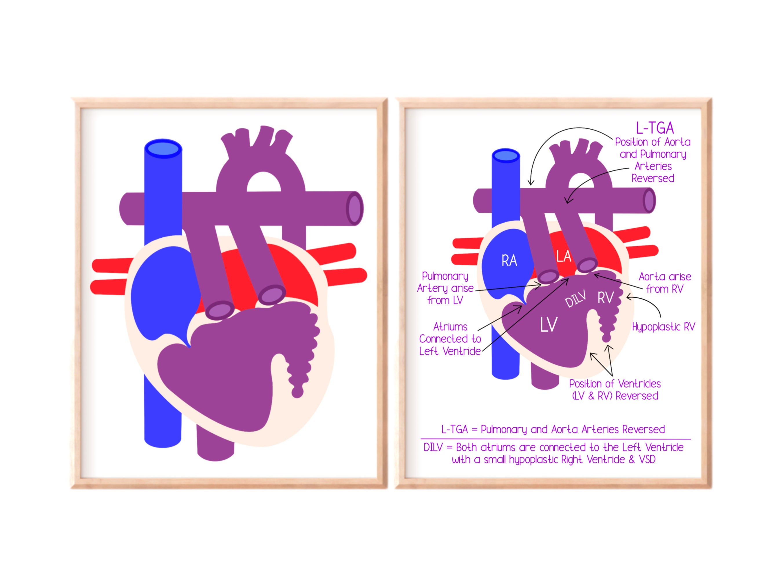 Custom COLOR CHD Heart Illustration Diagram Digital File - Etsy