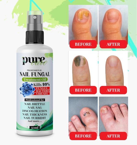 Anti Fungal Treatment Fungus Effective Toe Nail Repair - Etsy