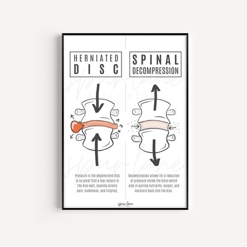 Spinal Decompression Print // Version 3 // Decompression - Etsy