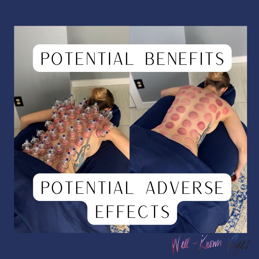 Cupping Therapy Informed Consent Form, Massage Therapy Cupping, Suction ...