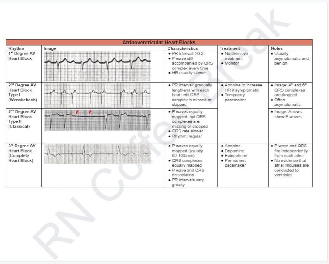 EKG Nursing NCLEX Study Notes - Etsy